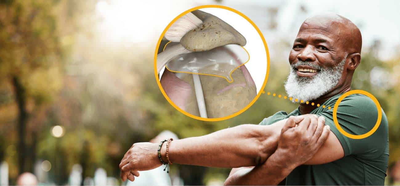 Novel Treatment for Massive Irreparable Rotator Cuff Tears - iOrtho ...