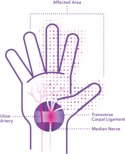 Carpal Tunnel Syndrome Treatment - CTR Procedures | iOrtho